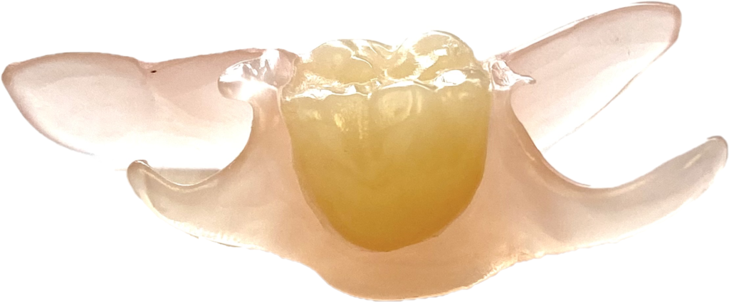Removable Restorations – DigiPros Dental Laboratory